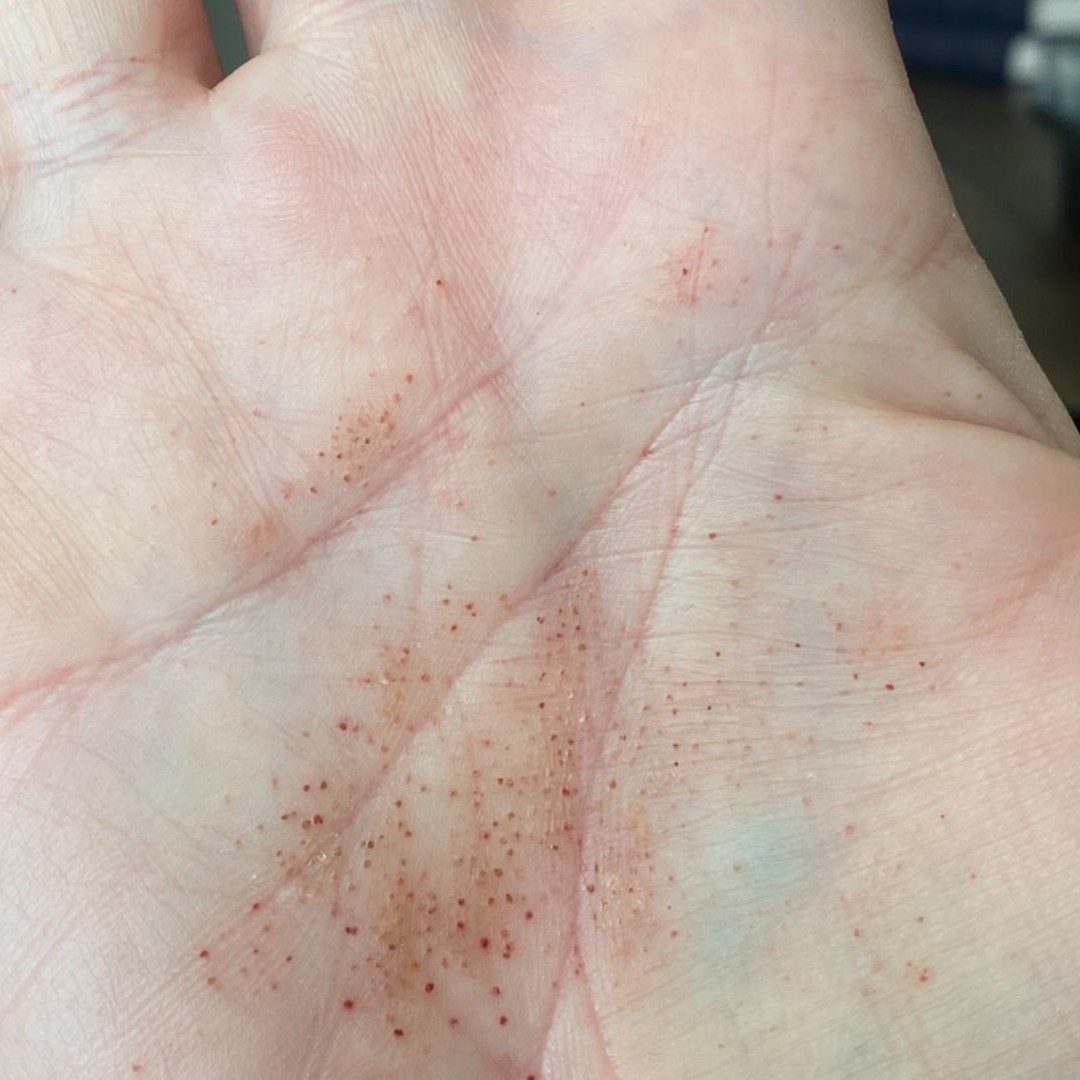 10 Novel Treatments for Chronic Itch, Eczema and Skin Infections - Suzy ...