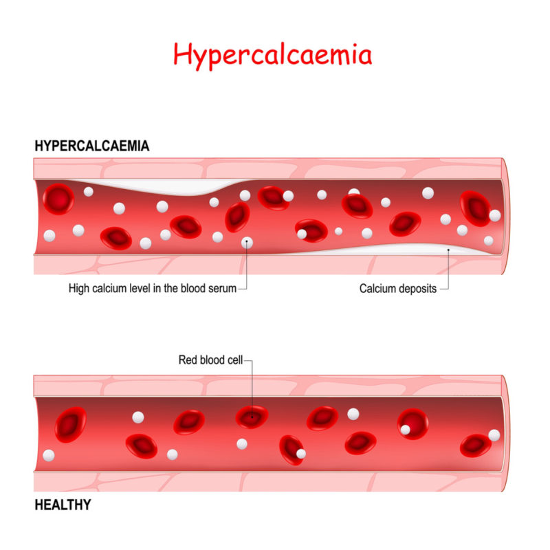 Calcium and Hypercalcemia Treatment Options - Suzy Cohen, RPh offers ...