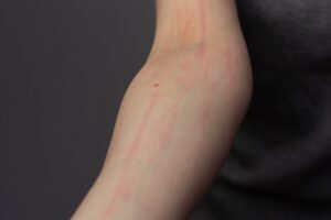 Dermatographia, Causes, Risk Factors and 7 Potential Treatments - Suzy ...