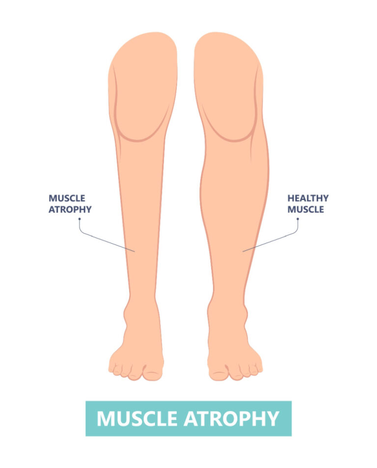 Tackling Unintended Weight Loss: 14 Ways to Manage Cachexia - Suzy ...