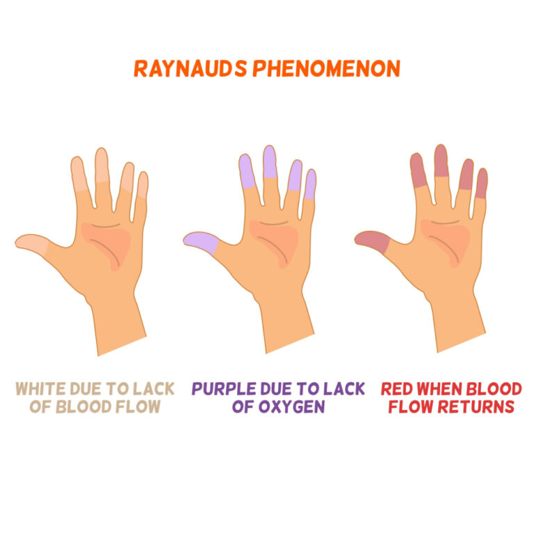 7 Holistic Approaches to Managing Raynaud's Phenomenon - Suzy Cohen ...